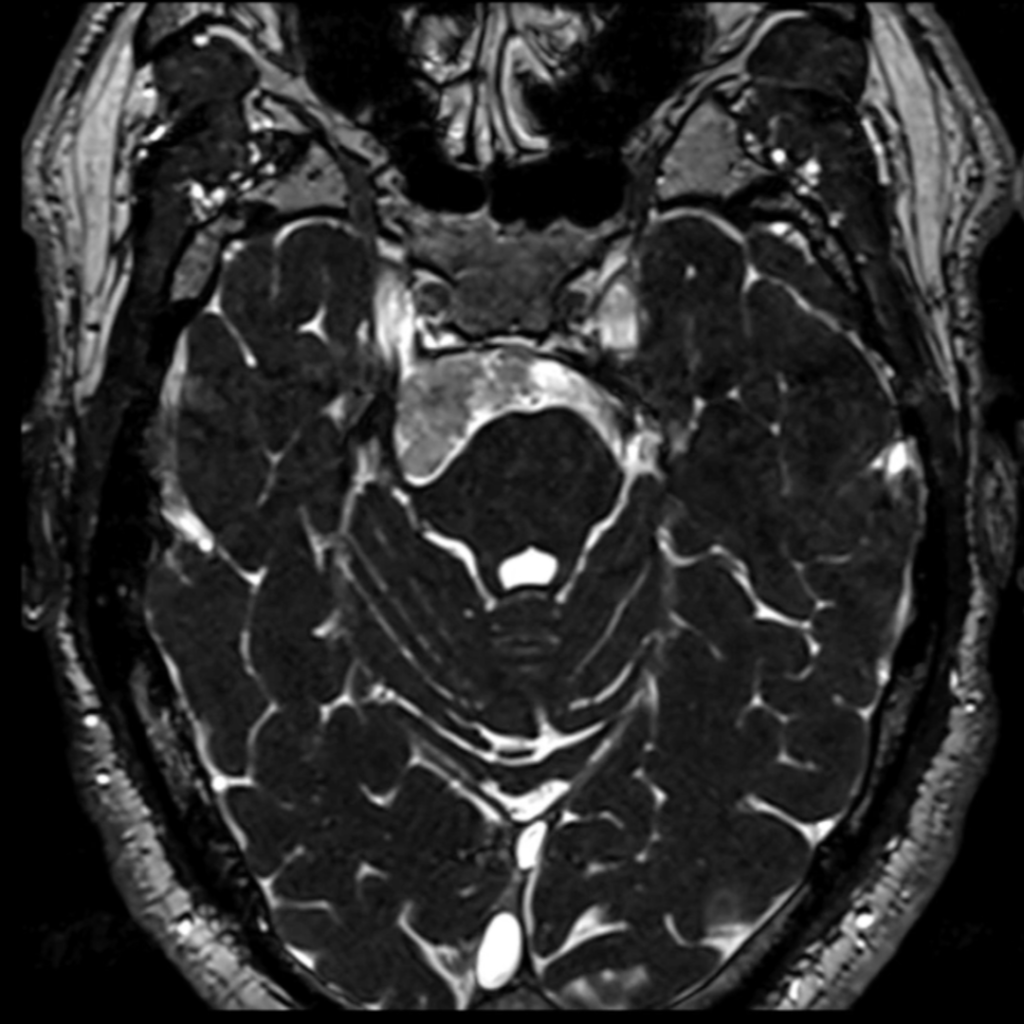 CPA Epidermoid Cyst with Rare Anatomic Variant: Anterior Inferior ...